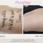 Erase and Embrace Tattoo Removal – Erase the Past, Embrace the Future ...