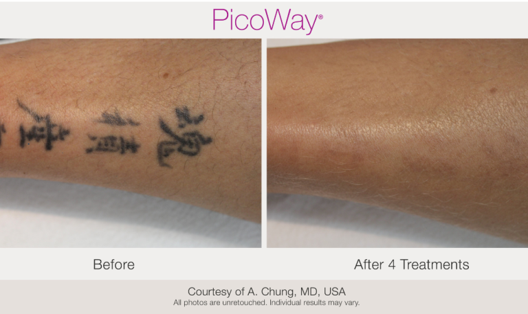 Erase and Embrace Tattoo Removal – Erase the Past, Embrace the Future ...