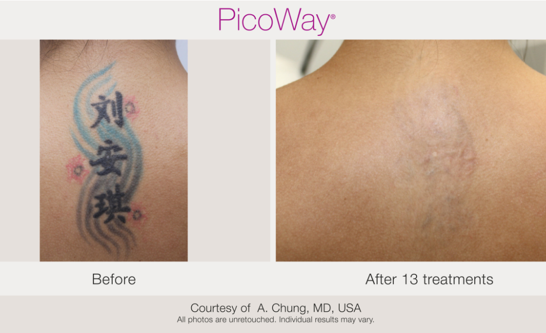 Erase and Embrace Tattoo Removal – Erase the Past, Embrace the Future ...