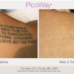 Erase and Embrace Tattoo Removal – Erase the Past, Embrace the Future ...