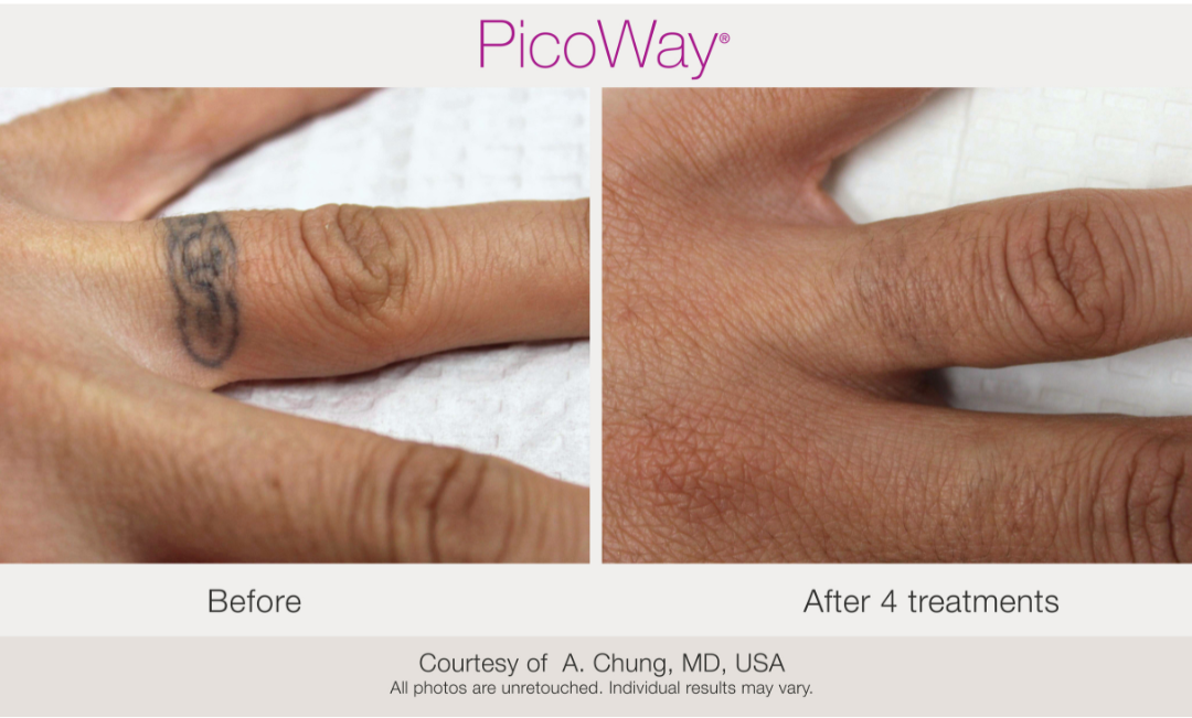 Erase and Embrace Tattoo Removal – Erase the Past, Embrace the Future ...