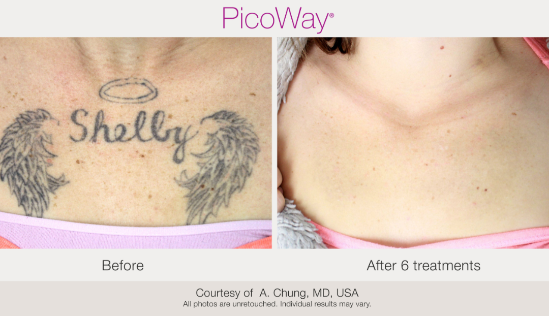 Erase and Embrace Tattoo Removal – Erase the Past, Embrace the Future ...