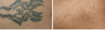 Erase and Embrace Tattoo Removal – Erase the Past, Embrace the Future ...