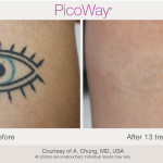 Erase and Embrace Tattoo Removal – Erase the Past, Embrace the Future ...