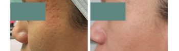 Erase and Embrace Tattoo Removal – Erase the Past, Embrace the Future ...
