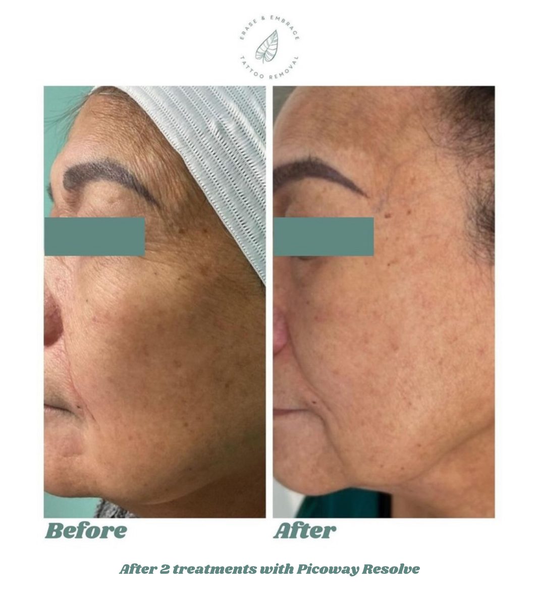 Erase and Embrace Tattoo Removal – Erase the Past, Embrace the Future ...